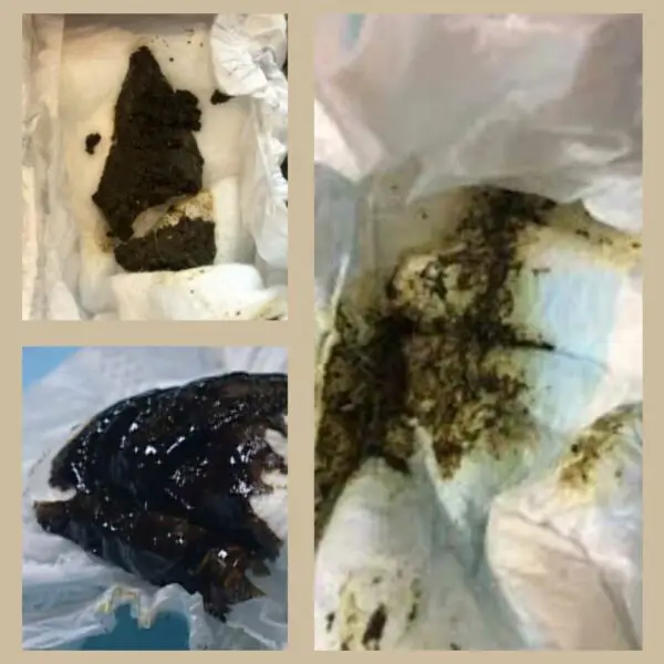 Coffee Ground Poop, Causes, Identification & Treatment 2025